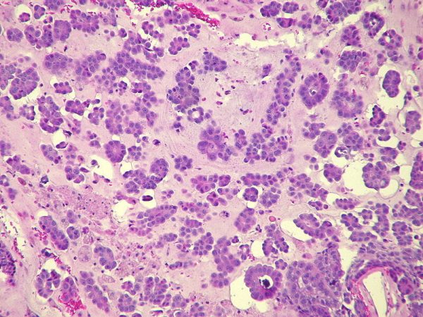 Carcinoma - Definition, Types, Explanation and Quiz | Biology Dictionary