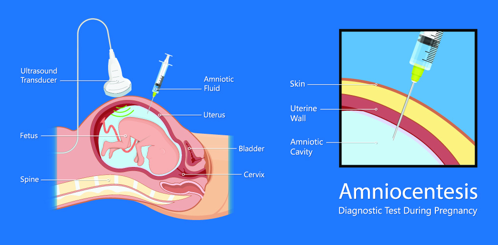 Amniocentesis Diagnostic Procedure Template Captain Printable Calendars