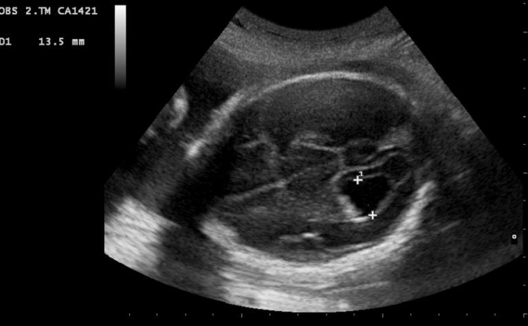 Choroid Plexus - The Definitive Guide | Biology Dictionary