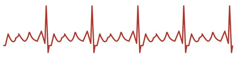 P Wave - The Definitive Guide | Biology Dictionary