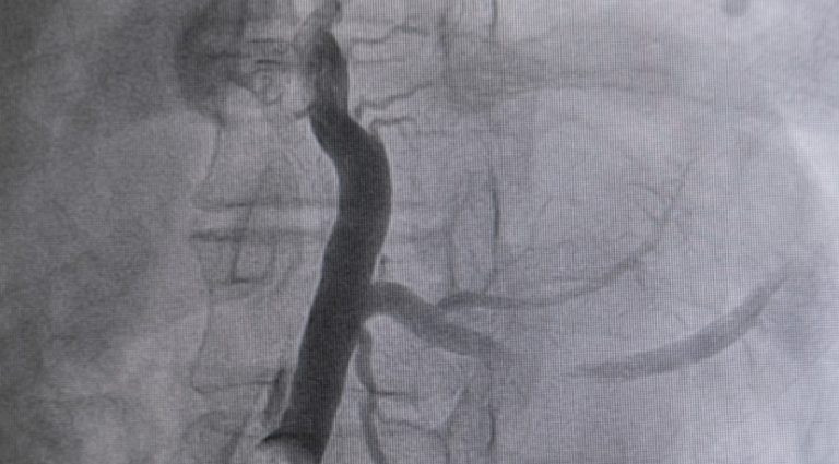 Coronary Sinus - The Definitive Guide | Biology Dictionary