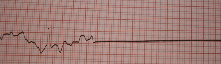 P Wave - The Definitive Guide | Biology Dictionary