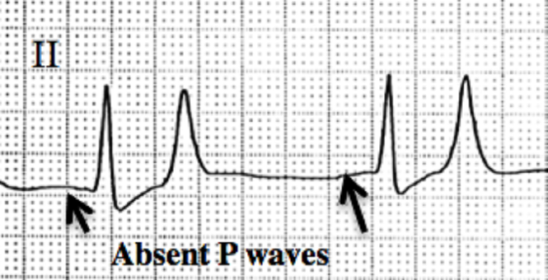 P Wave - The Definitive Guide | Biology Dictionary