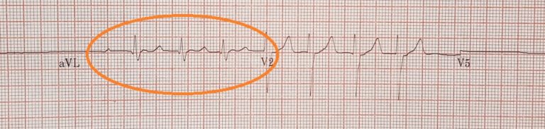 P Wave - The Definitive Guide | Biology Dictionary