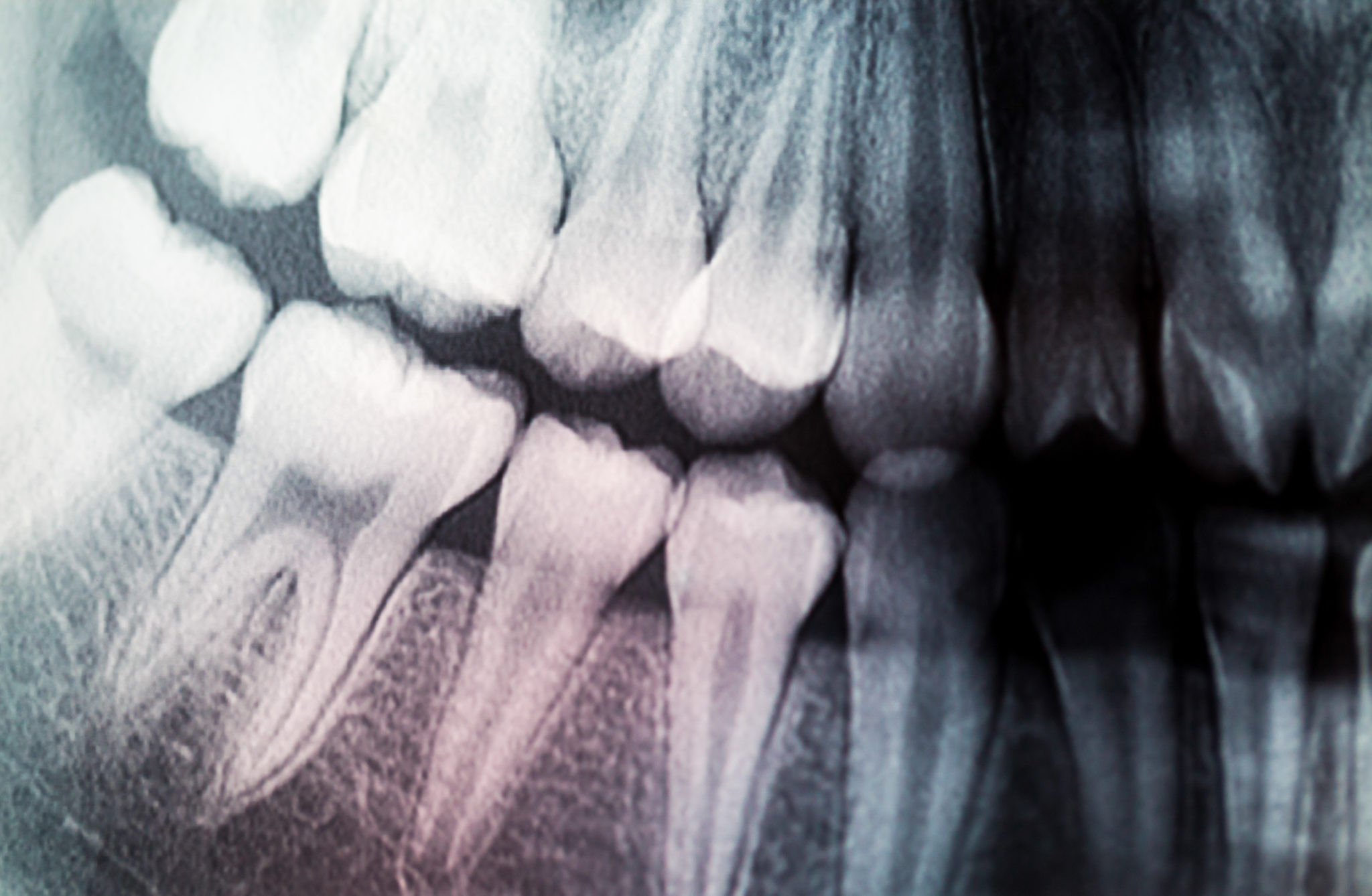 Maxilla Bone - The Definitive Guide