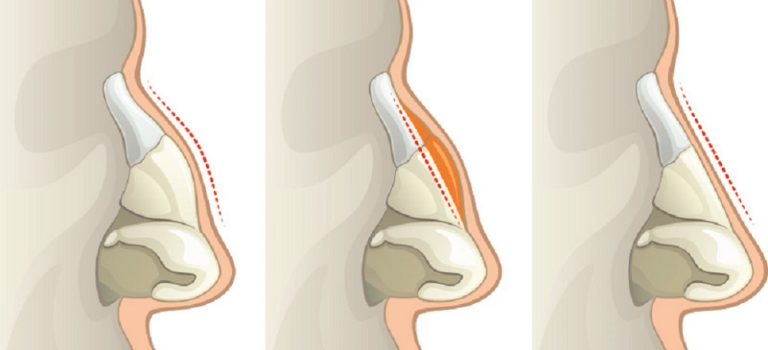 Nasal Bone - The Definitive Guide | Biology Dictionary