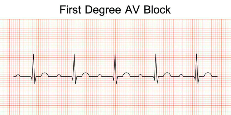 PR Interval - The Definitive Guide | Biology Dictionary