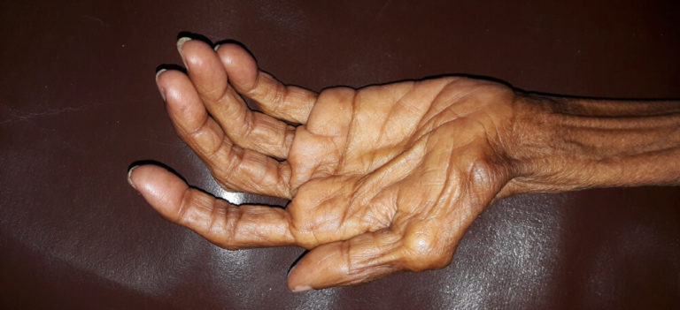 Muscle Atrophy - The Definitive Guide | Biology Dictionary