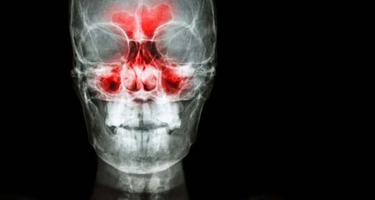 Paranasal Sinuses - The Definitive Guide | Biology Dictionary