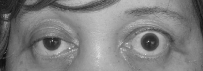 Botulinum Toxin - The Definitive Guide | Biology Dictionary