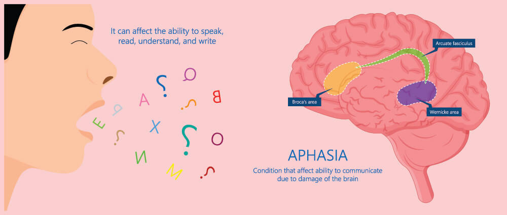Expressive Aphasia The Definitive Guide Biology Dictionary