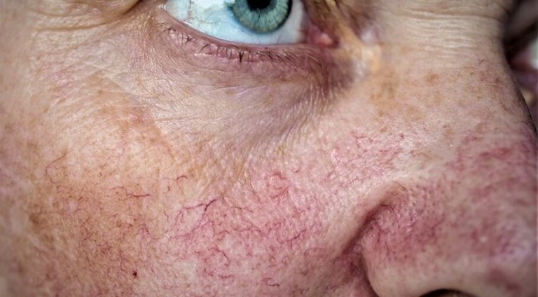 Capillary - The Definitive Guide | Biology Dictionary