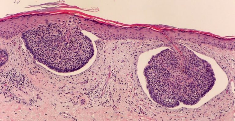 Basal Cell - The Definitive Guide | Biology Dictionary