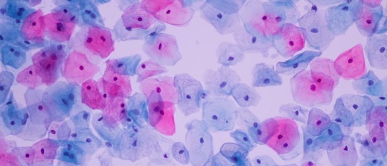 Squamous Cell - The Definitive Guide
